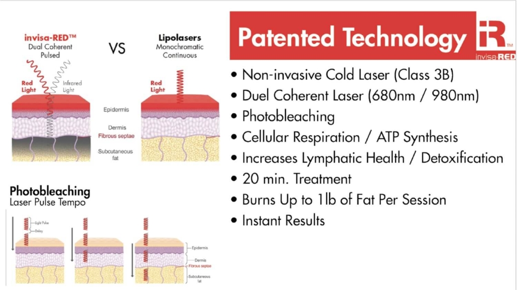 Invisa-red Lipo laser in Windsor | Norco Chiropractic